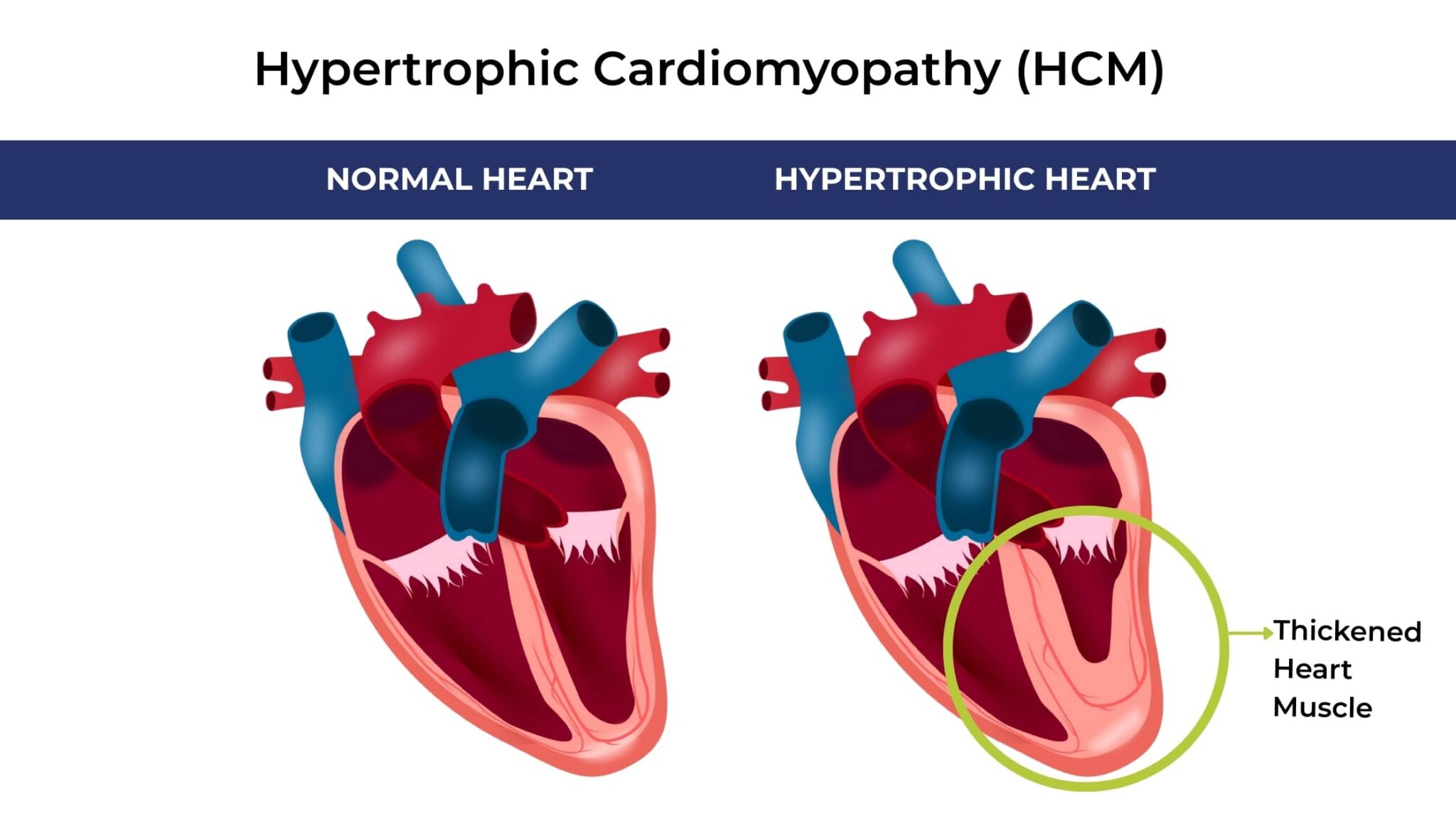 Hypertrophic Cardiomyopathy (HCM) - Virginia Cardiovascular Specialists